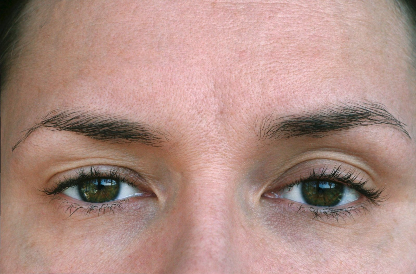 Ptosis palpebral: ¿Qué es y cómo se trata? - Dr. Peraza